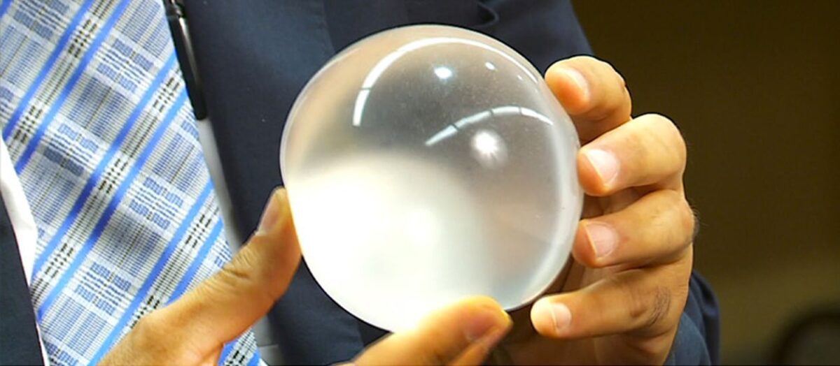 What is Orbera Weight Loss