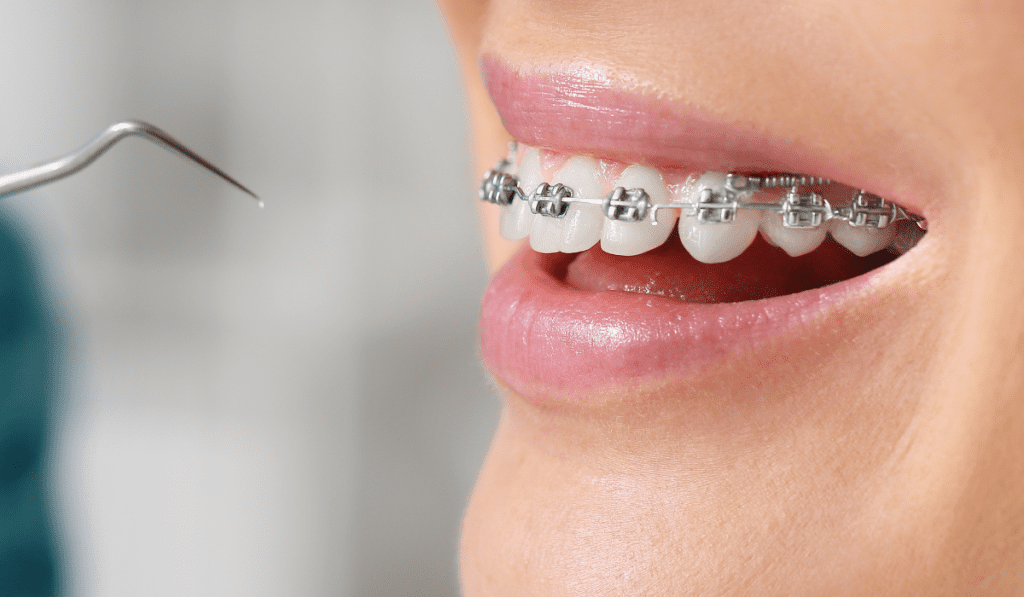 How to Sleep with Braces - Wellness Voice